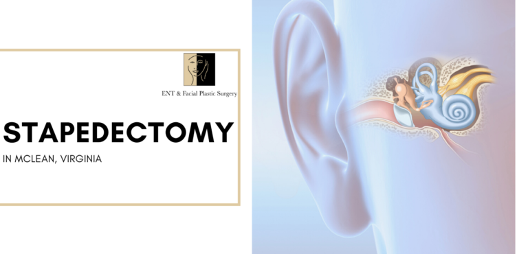 Stapedectomy - Top Plastic Surgeon In McLean, VA